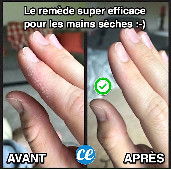 Mains Sèches à Cause Du Froid ? Le Remède Naturel Super Efficace.