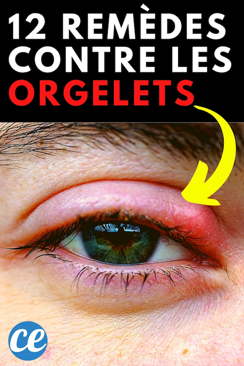 Orgelets : Les 12 Meilleurs Remèdes Pour S'en Débarrasser Très Vite.