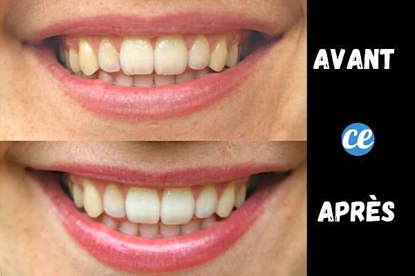 Huile de Coco Pour les Dents : 4 Bienfaits Étonnants Que Personne Ne Connaît.