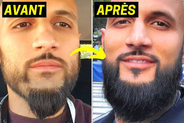 Huile De Ricin Barbe Avant Après