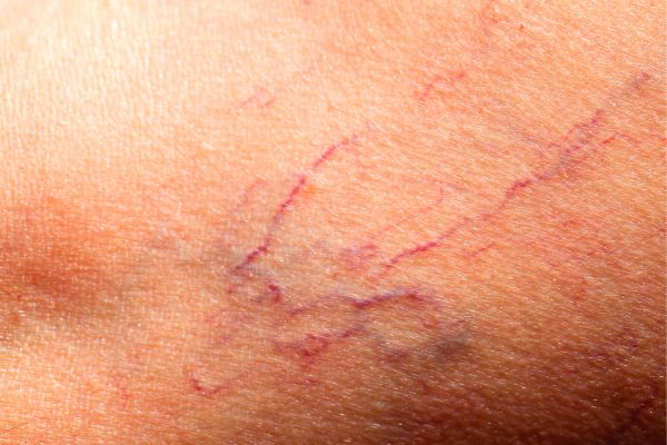 Pourquoi Certaines Personnes Ont les Veines Apparentes