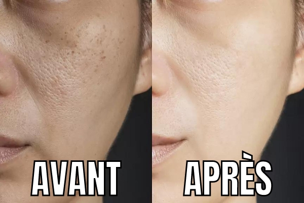 Pores Dilatés 10 Solutions Radicales Pour Les Resserrer Au Naturel
