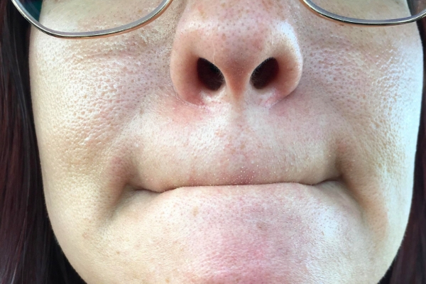 Pores Dilatés : 10 Solutions Radicales Pour les Resserrer au Naturel.