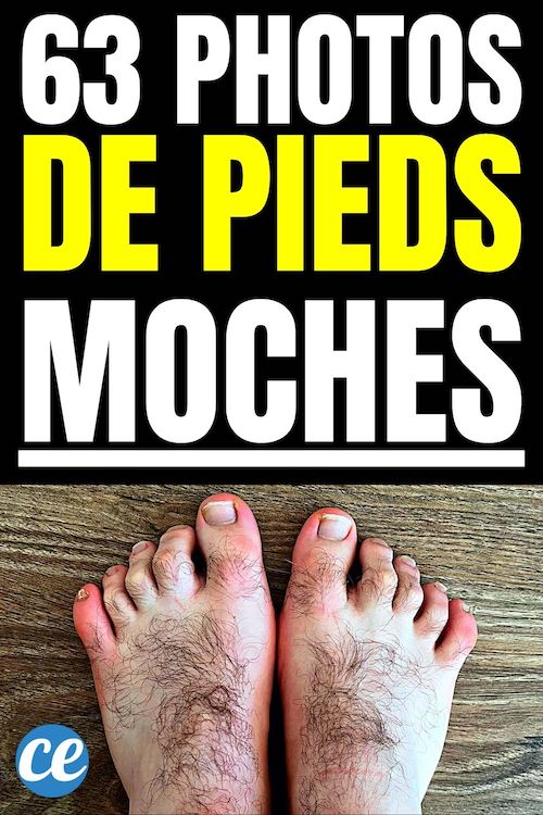 Top 63 des Pieds les Plus Moches du Monde.