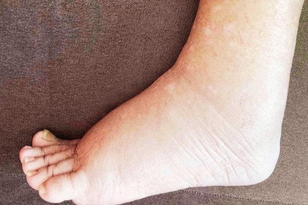 Rétention d’Eau : Le Remède de Grand-Mère Pour Dégonfler Rapidement.