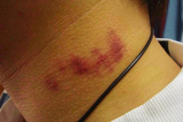 Les Suçons Sont-ils Dangereux