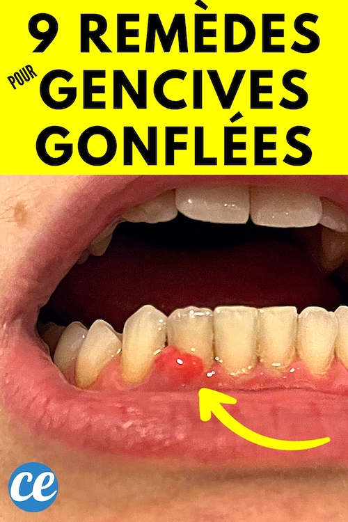 Gencives Gonflées : 9 Traitements Naturels Pour les Faire Dégonfler.