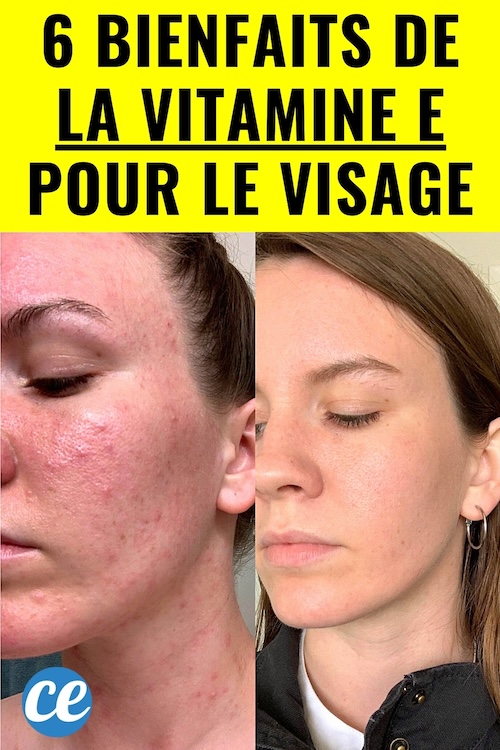 Vitamine E Visage : Bienfaits et Comment l'Utiliser Pour une Peau Lisse et Éclatante.