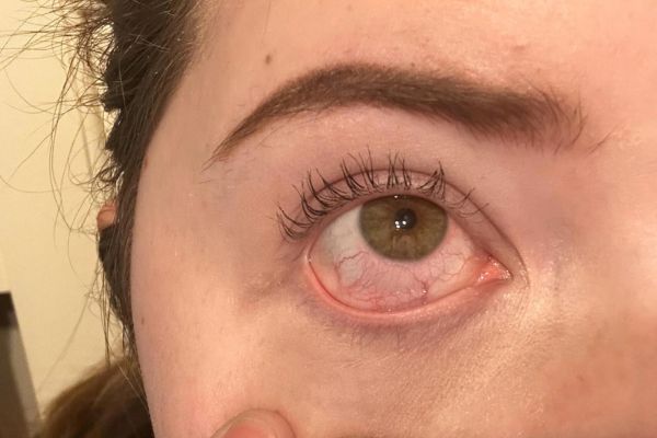 Piment Dans les Yeux : Comment Soulager Rapidement la Douleur