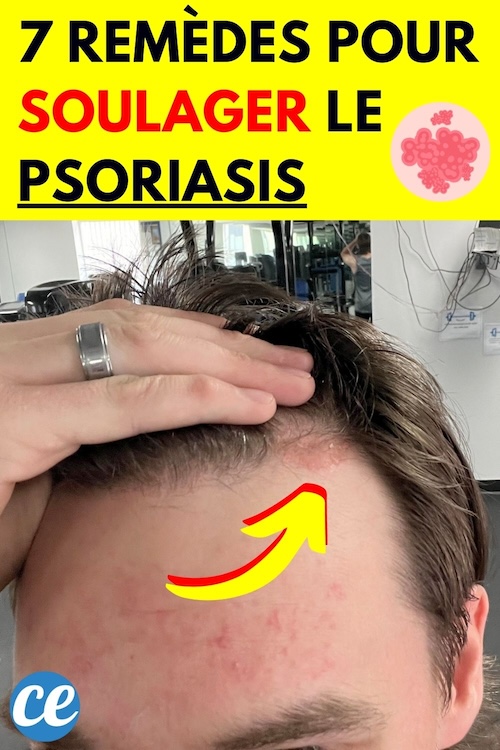 Les 7 Remèdes Efficaces et Naturels pour Soulager le Psoriasis.