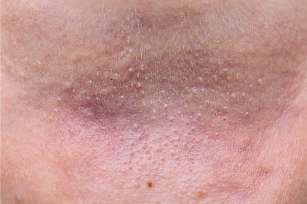 Si Vous Remarquez Ces Points Rouges sur votre Peau, Voici Ce Qu’ils ...