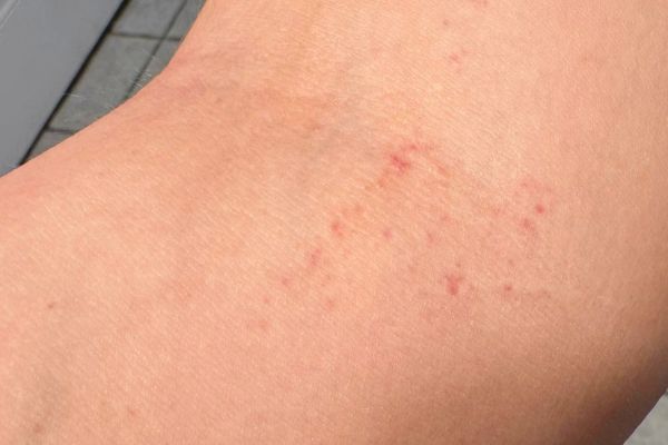 Si Vous Remarquez Ces Points Rouges sur votre Peau, Voici Ce Qu’ils ...