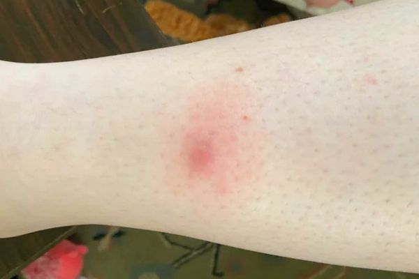 Si Vous Remarquez Ces Points Rouges sur votre Peau, Voici Ce Qu’ils ...