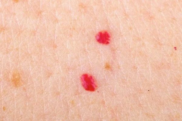Si Vous Remarquez Ces Points Rouges sur votre Peau, Voici Ce Qu’ils ...