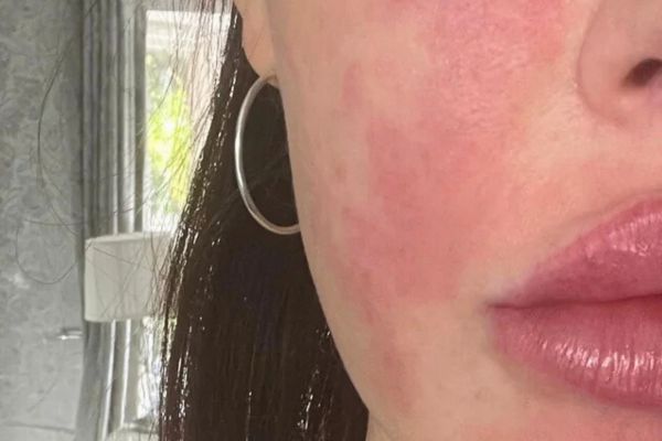 Si Vous Remarquez Ces Points Rouges sur votre Peau, Voici Ce Qu’ils ...