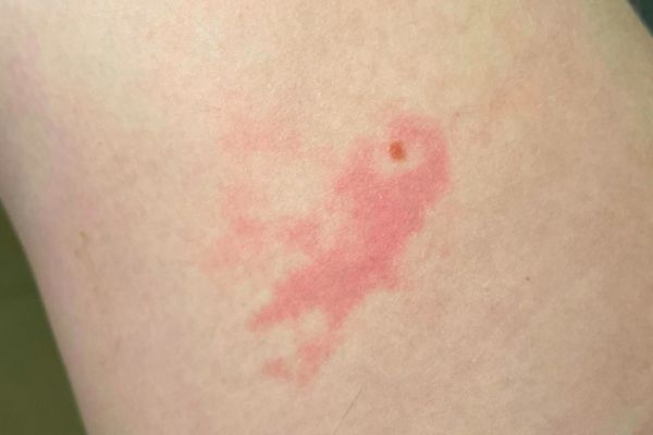 Si Vous Remarquez Ces Points Rouges sur votre Peau, Voici Ce Qu’ils ...