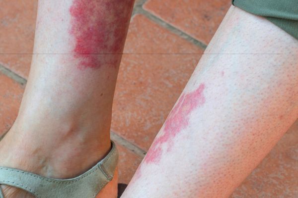 Si Vous Remarquez Ces Points Rouges sur votre Peau, Voici Ce Qu’ils ...