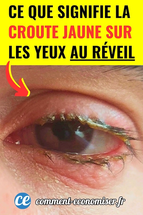 La Plupart des Gens Ne Savent Ce Que Signifie la Croute Jaune Qui ...