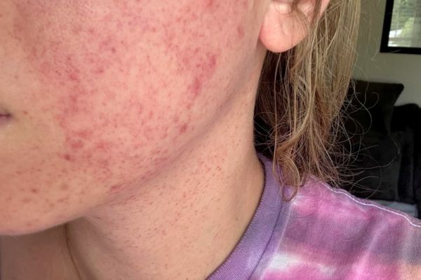 Que Signifie des Boutons Rouges Sur le Bras