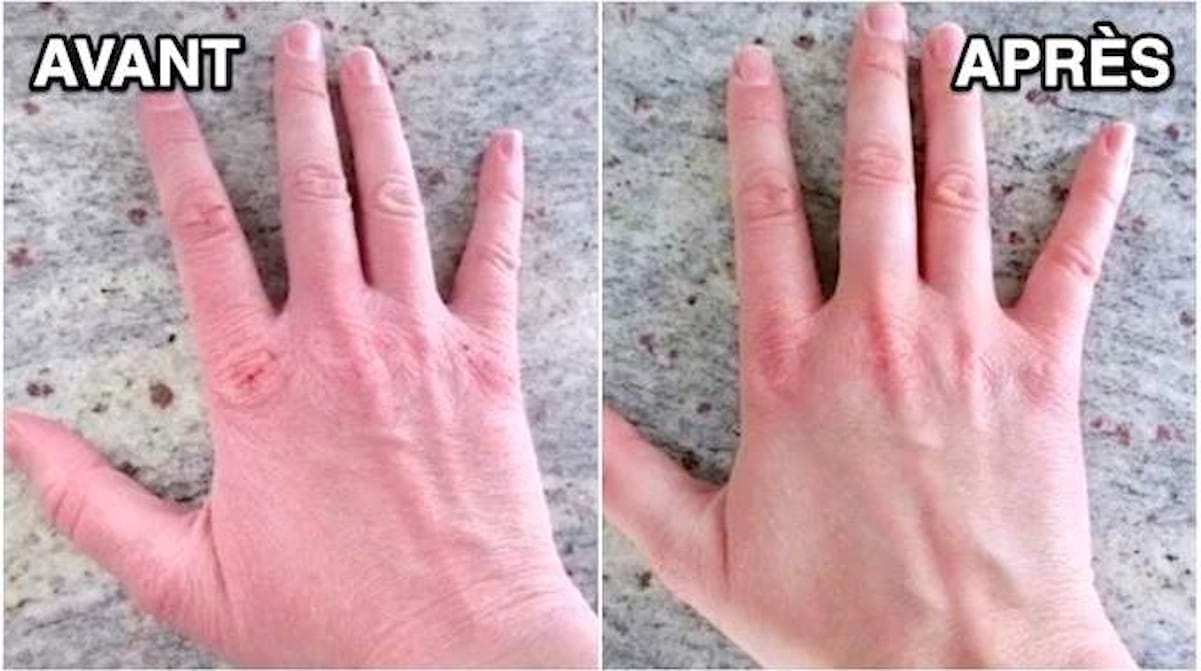 Mains Abîmées Par le Gel Hydroalcoolique ? Le Remède Miracle et Instantané.